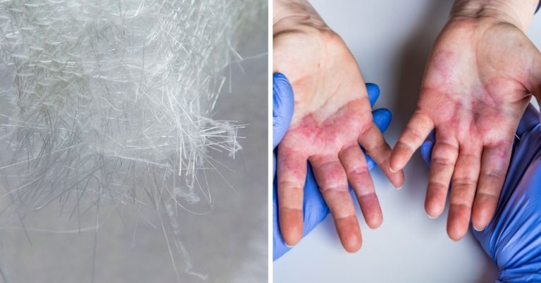 How to Get Fiberglass Out of Skin - Homewares Insider